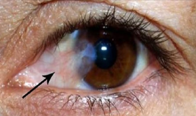 Elimina esas carnosidades de tus ojos de forma rápida y natural con ...